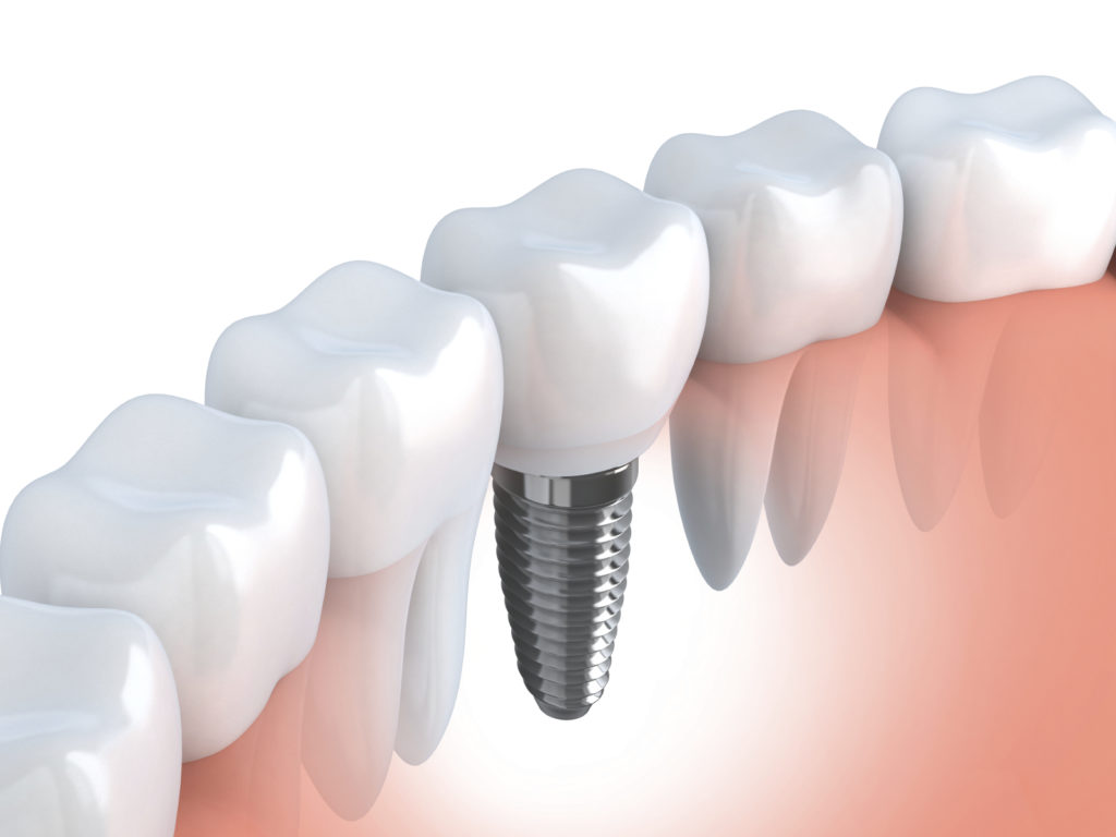 For Dental Implants, Canton, GA, Trusts Drs. Lee - Dentistry at Hickory ...